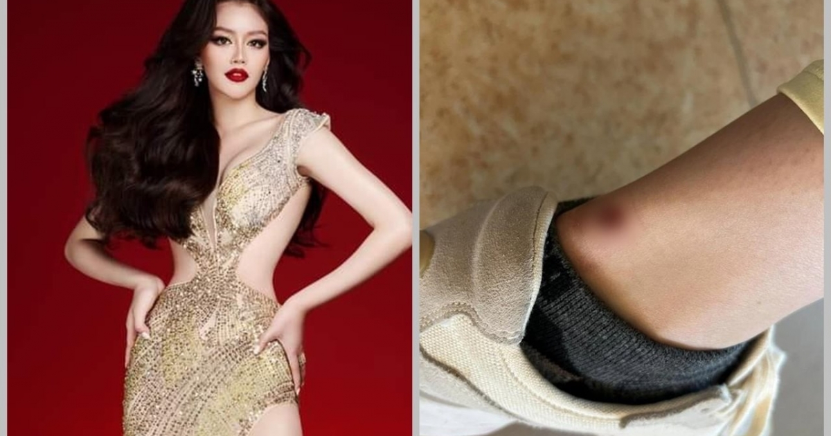 Đặng Thanh Ngân bị thương ở chân nhưng vẫn 'giấu nhẹm' fan để chinh chiến tại Miss Supranational ...